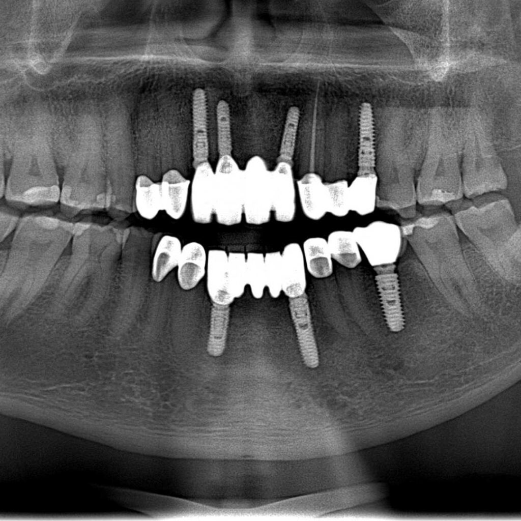 İmplant Tedavisi - MDC Ağız ve Diş Sağlığı Polikliniği